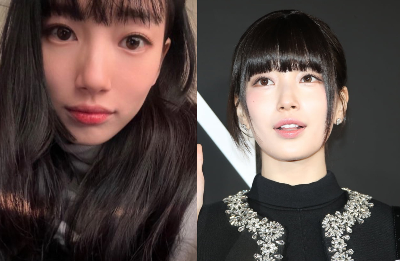 Suzy’s Secret to Brighter Eyes: What Is Conjunctival Nevus Removal ...